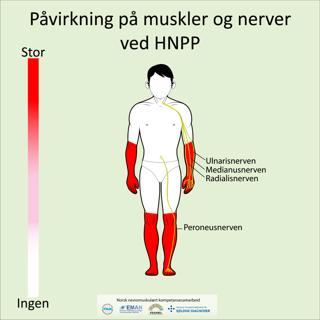Arvelig nevropati med trykkbetingede lammelser (HNPP) - Frambu
